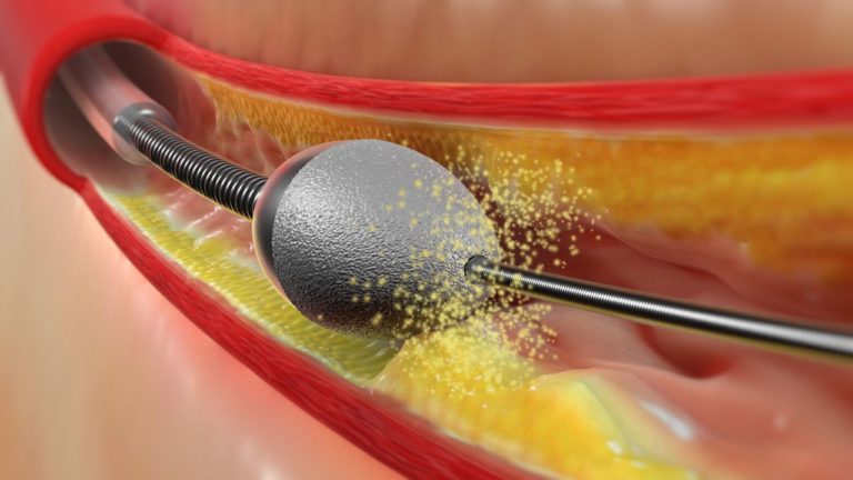 Angioplastia coronariana com aterectomia rotacional (Rotablator ...